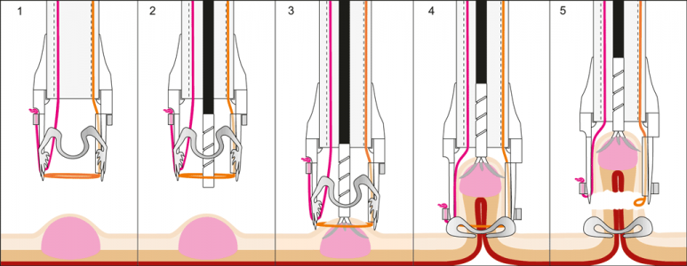 gastroduodenal FTRD® - InMedi GmbH - Innovative Medizintechnik in der ...